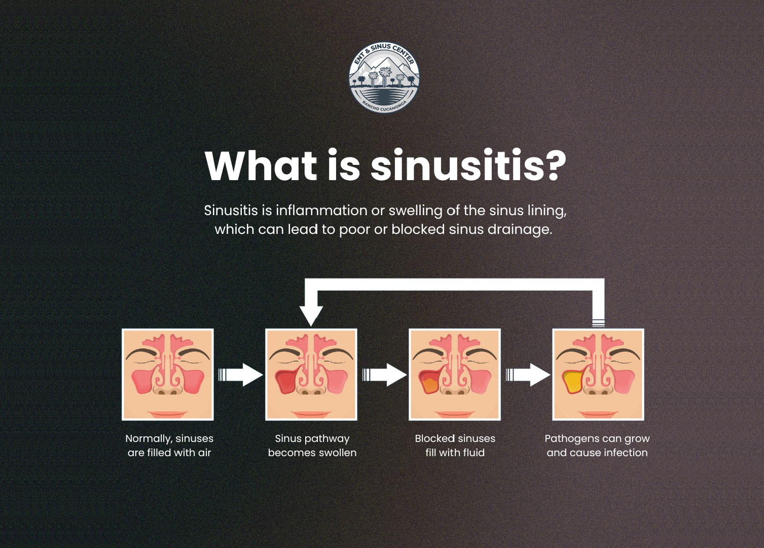 WHAT is Sinusitis | ENT & Sinus Center
