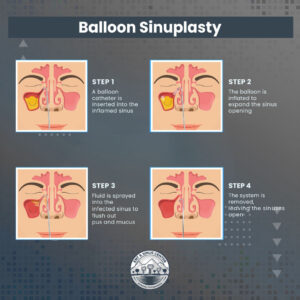 WHAT is Sinusitis | ENT & Sinus Center