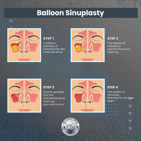WHAT is Sinusitis | ENT & Sinus Center